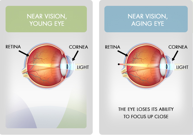 What Causes Presbyopia? | VisAbility Micro Insert System What Causes Presbyopia? | VisAbility Micro Insert System
